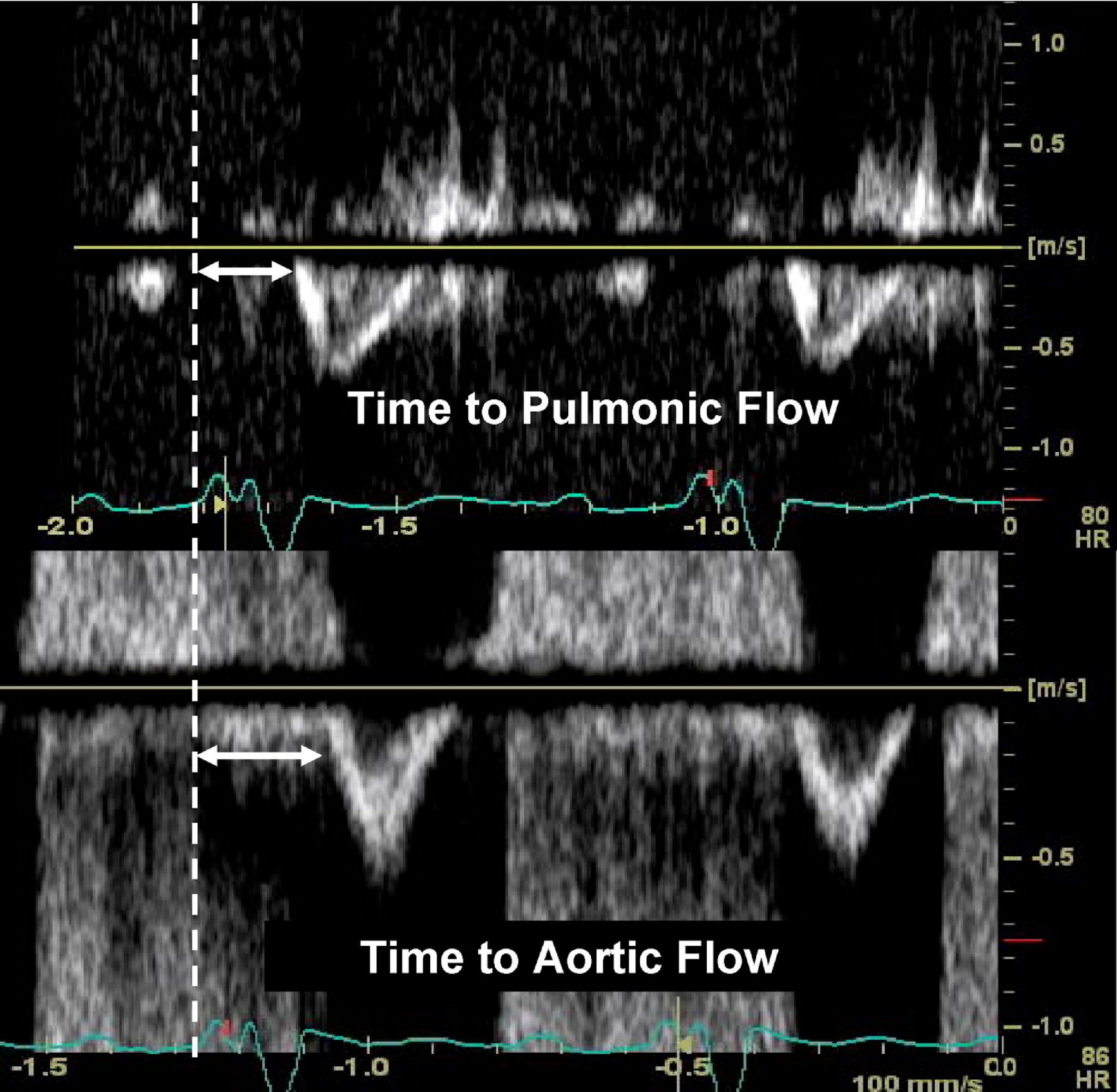 Resynchronization Therapy – ASE