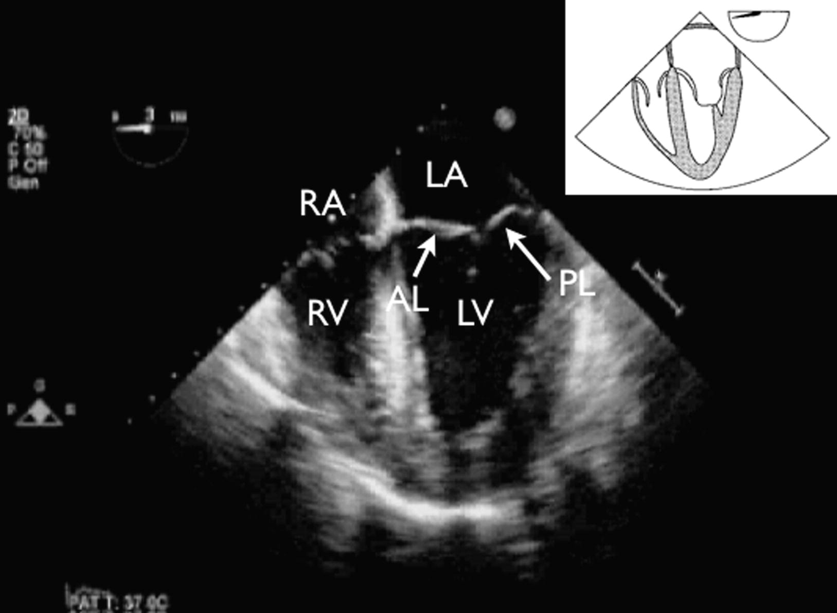 Basic Perioperative TEE – ASE