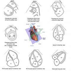 Right Heart in Adults & Pulmonary Hypertension – ASE