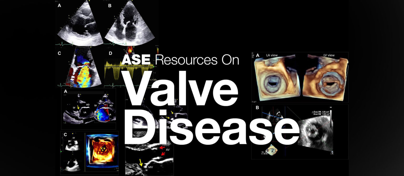 Valve Disease - ASE